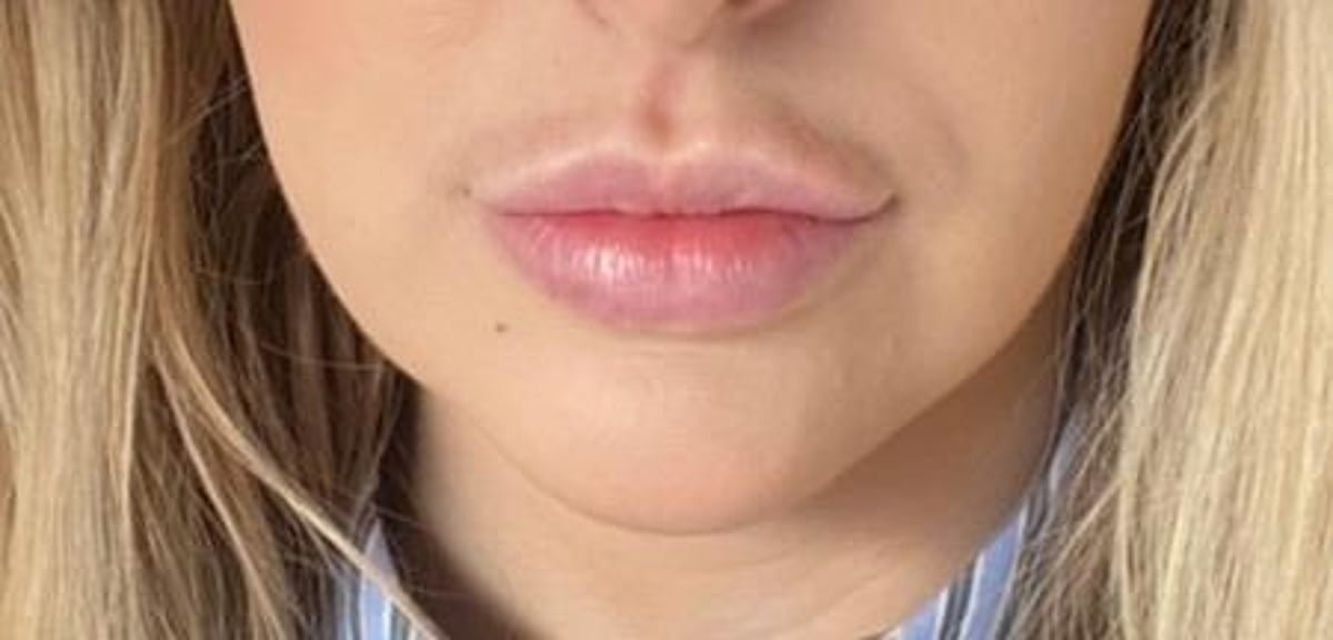 Lip Filler Migration: Causes, Treatment, and How to Prevent It - Doctor ...