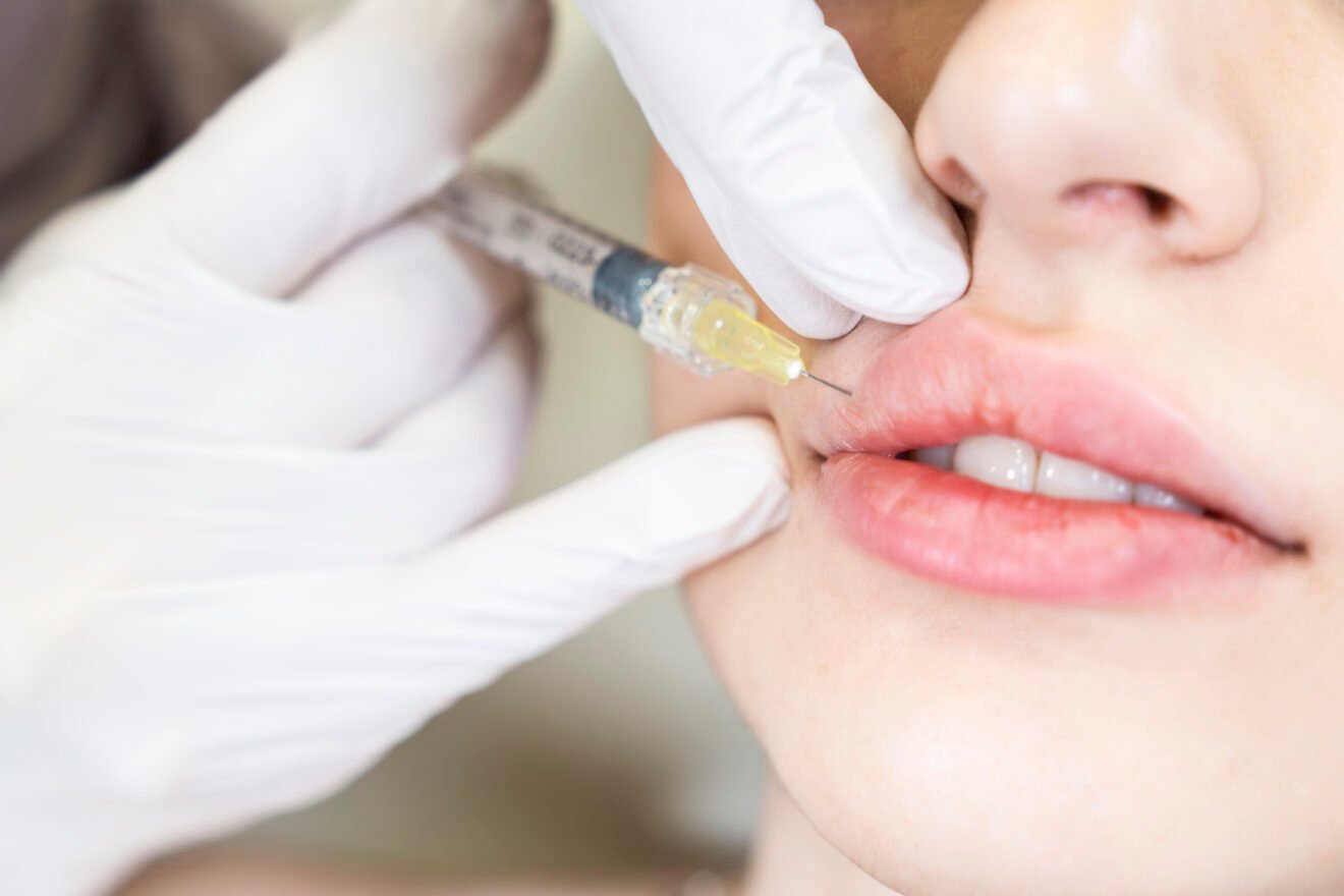 Lip Filler Migration: Causes, Treatment, and How to Prevent It - Doctor ...